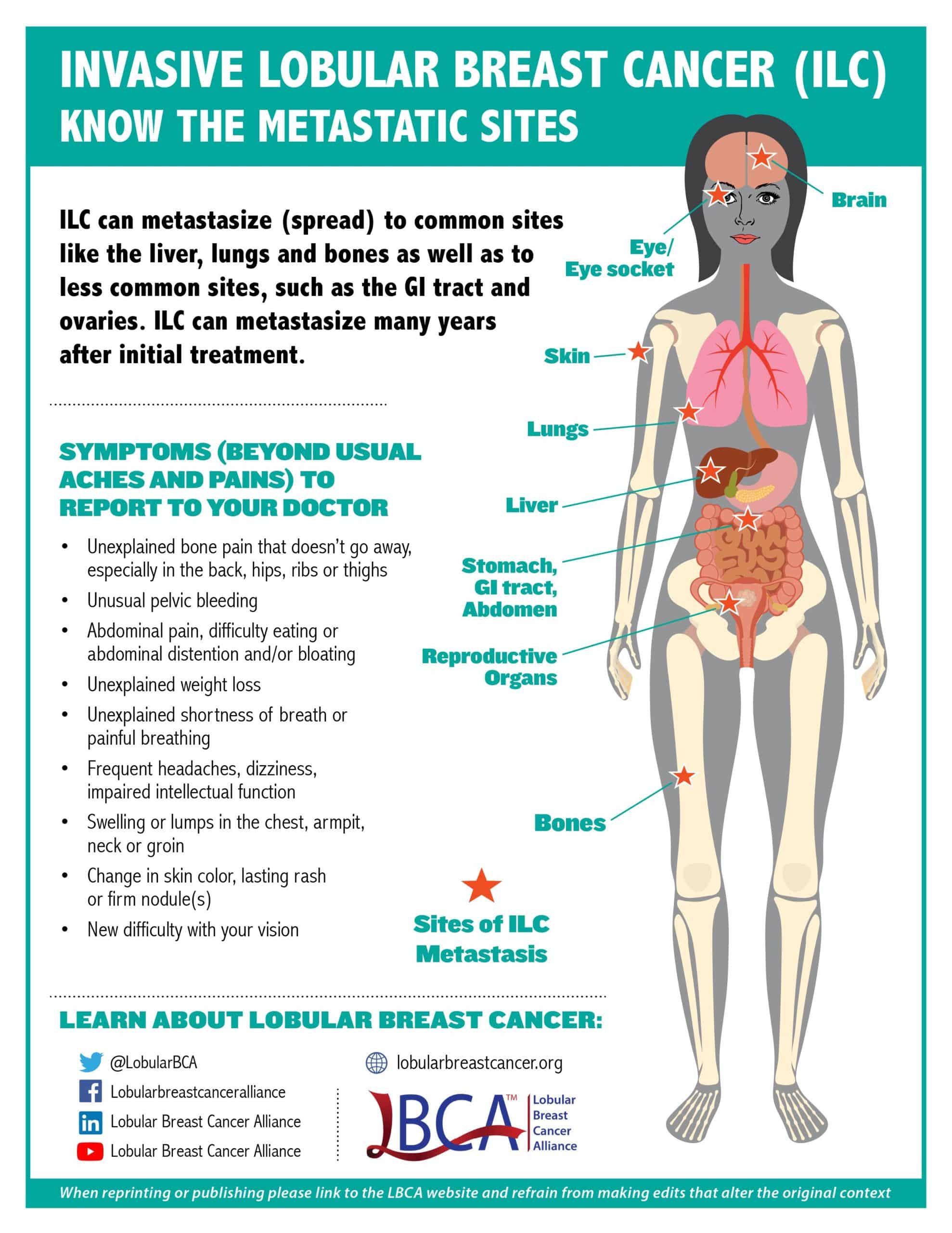 ILC Fact Sheet The Lobular Breast Cancer Alliance