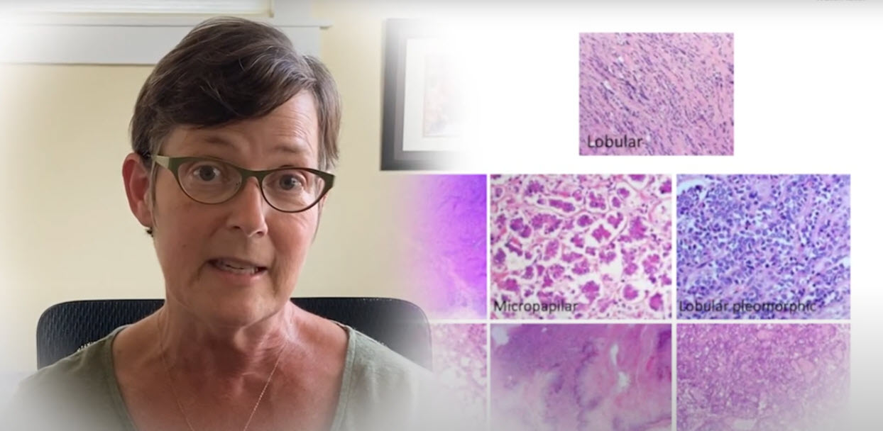 Lobular Breast Cancer Alliance (LBCA)